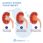 Kidney Stones: The Ultimate Beginner’s Guide - CompactCath