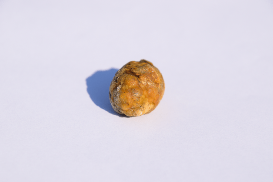 Bladder Stones: Causes and Symptoms - CompactCath